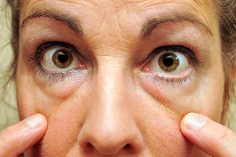 How to remove puffiness under the eyes quickly: 5 ways